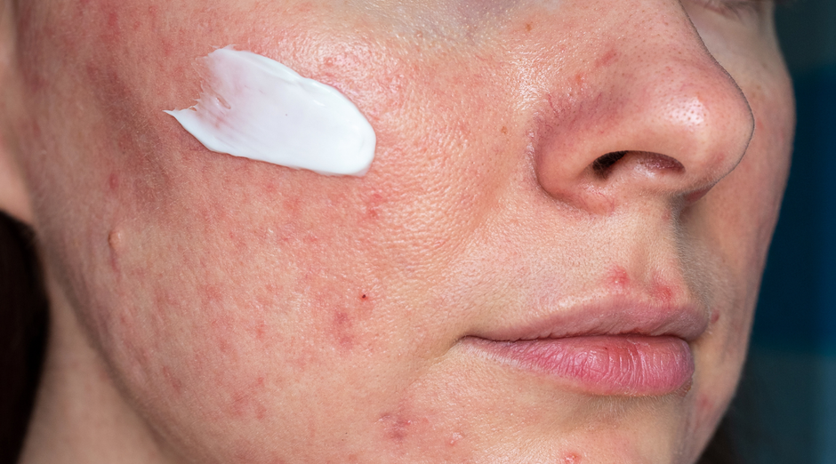 Lupus Rash vs. Rosacea: How to Tell the Difference – Aussie Pharma Direct