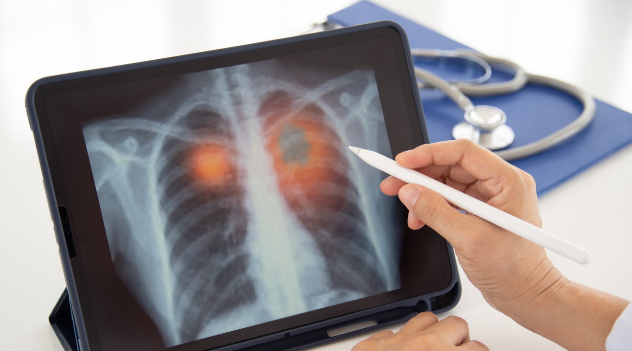 Mycoplasma Pneumonia: How It Differs from Other Respiratory Illnesses ...