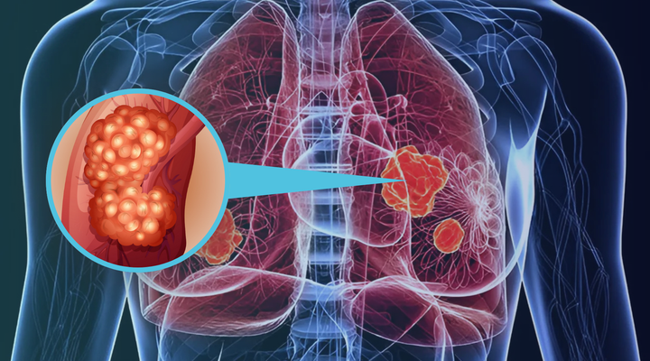 Popcorn Lung: What is It, and What Makes You at Risk of Having It ...