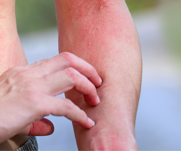 Rashes 101: Everything You Should Know about Skin Rashes – Aussie ...