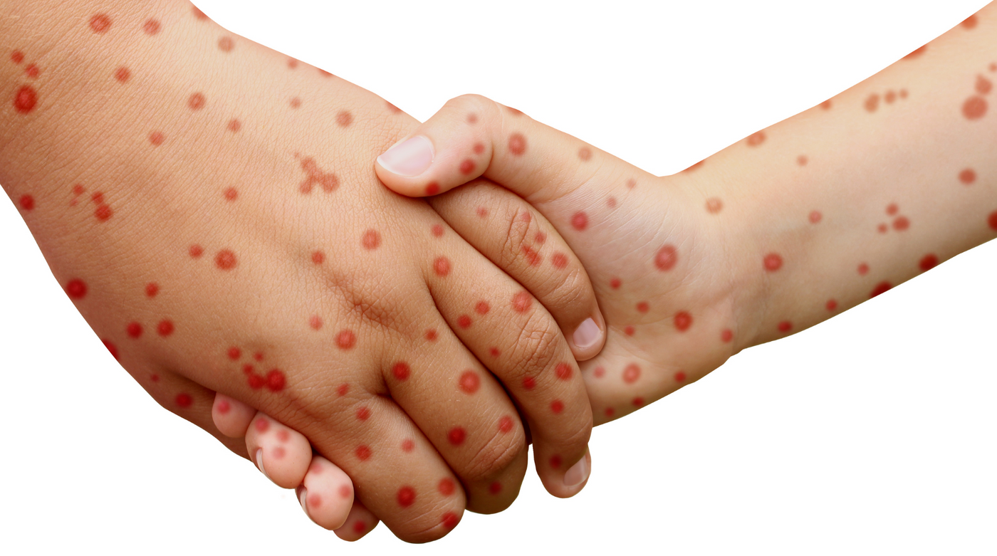 Measles: How to Identify, Treat and Shield Against It – Aussie Pharma ...