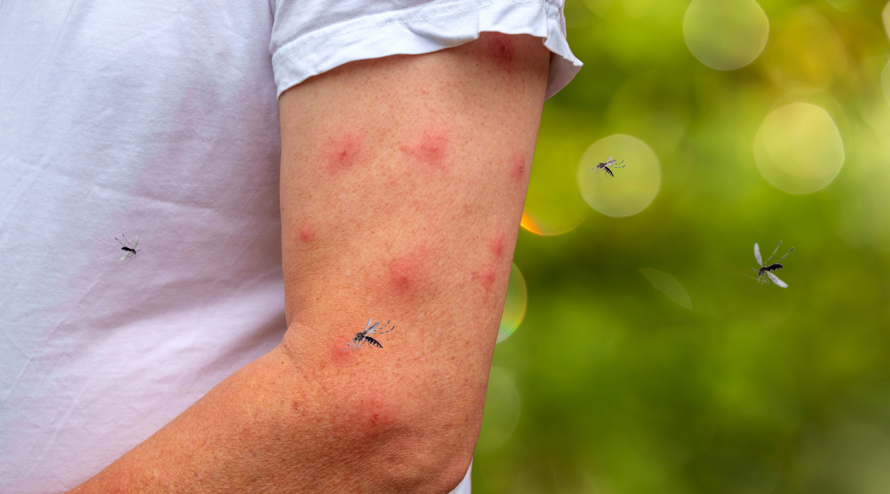 Why Do Mosquito Bites Affect Some People More Than Others? – Aussie ...